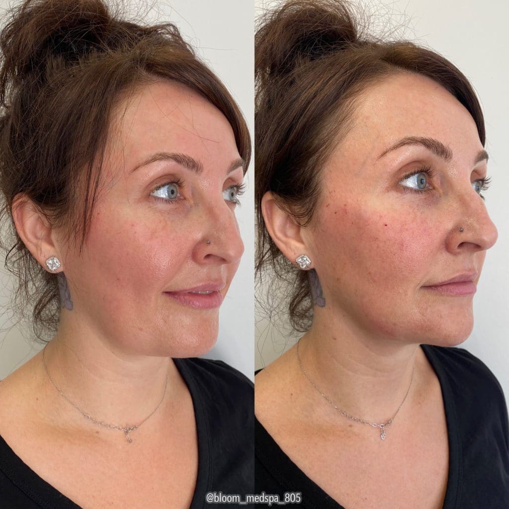 Dermal Fillers for Facial Volume | Ventura, CA | Bloom Med Spa